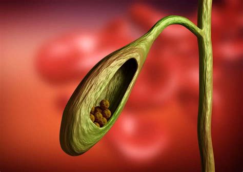 Choledocholithiasis What Is Choledocholithiasis