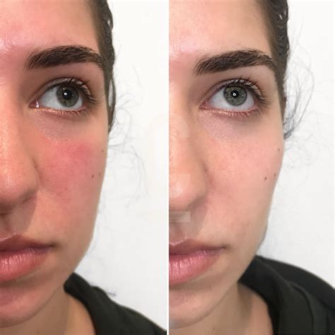 Cheek Contouring Fillers Cosmetic Connection