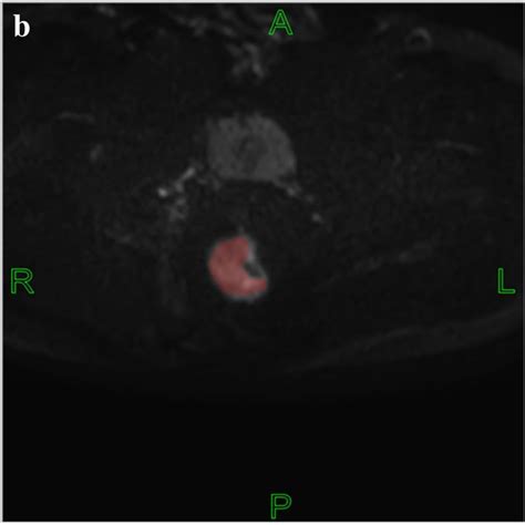 A C Manual Segmentation Of Rectal Cancer In Intravoxel Incoherent Motion Download Scientific