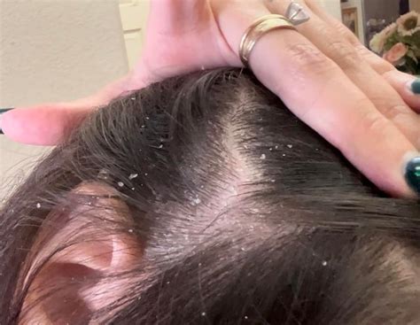 Dandruff Or Dry Scalp My Scalp Is Literally Snowing It Leaves All The Flakes On My Tshirt I