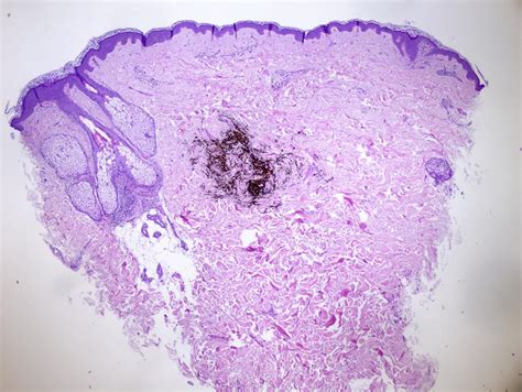 Blue Nevus Histology