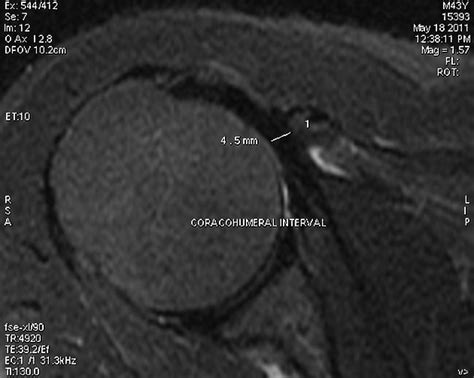 Subcoracoid Impingement Pacs