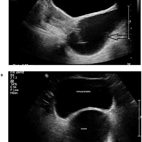 A B Sagittal And Transverse Ultrasound Sections Of The Pelvis A