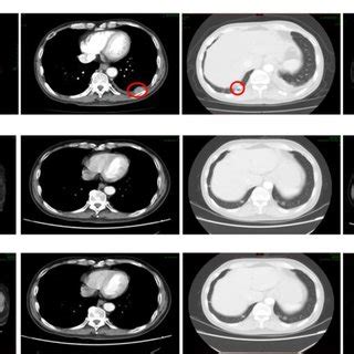 CT Scans For One Patient Achieving PR In Dose Expansion Cohort Before Download Scientific