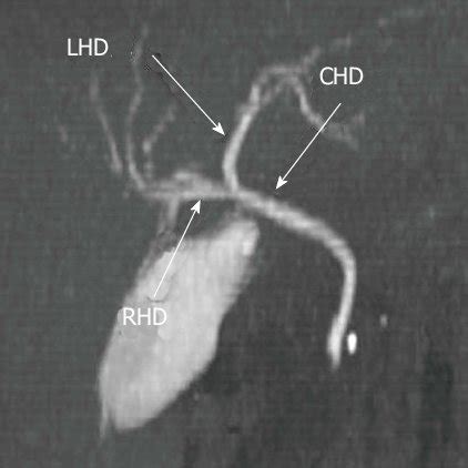 Michel S Classification Of Hepatic Arterial Variants Download Table