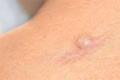 Epidermal Sebaceous Skin Cyst Epidermoid Cyst Removal In Singapore
