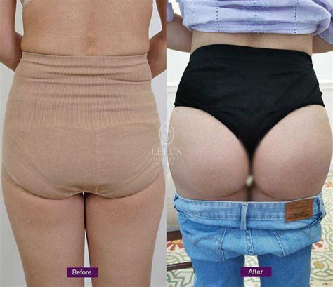Buttock Augmentation Gallery Lelux Hospital