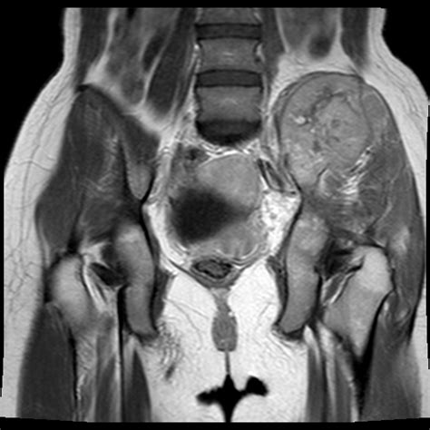 Iliac Bone Ewing Sarcoma Image