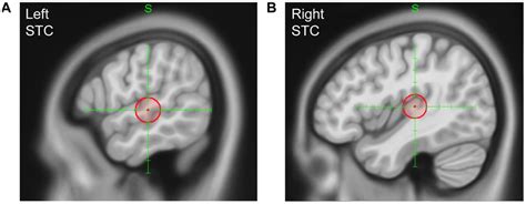 Stimulation Sites In The Superior Temporal Cortex Location Of A The