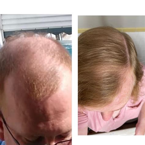 Why Take Semi Tranny Drugs Like Finasteride To Reverse Hair Loss