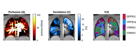 Preful Mri Method Enables New Insights Into Lung Function Deutsches
