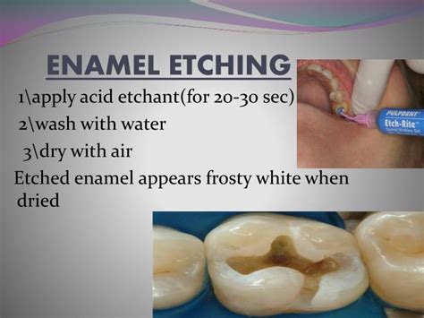 Types Of Enamel Etching At April Langdon Blog