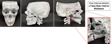 Craniectomy For Cerebral Bone Tumor Resection 3d4med