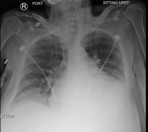 Congestive Heart Failure X Ray Jetem