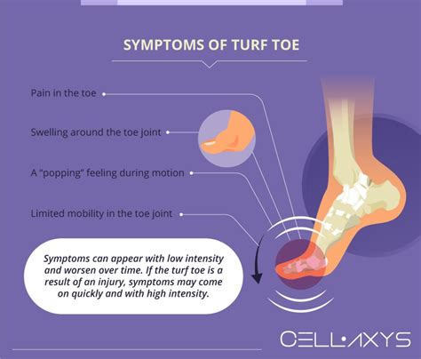 How To Treat Turf Toe At Home At Nicholas Olson Blog