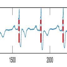 PDF Analysis Of Pan Tompkins Algorithm Performance With Noisy ECG Signals