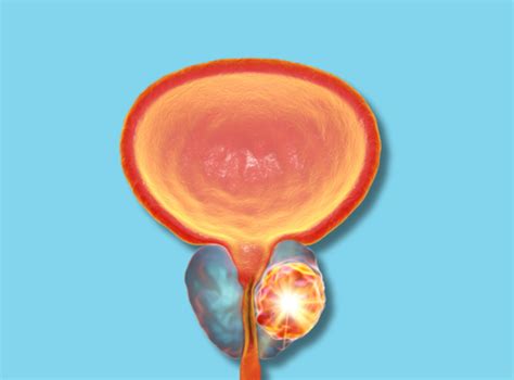 Prostate Ultrasound Solomed