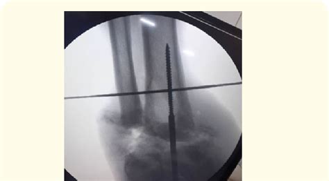 Fluoroscopy Radiograph Ap Showing Postoperative Arthrodesis Of Ankle Download Scientific