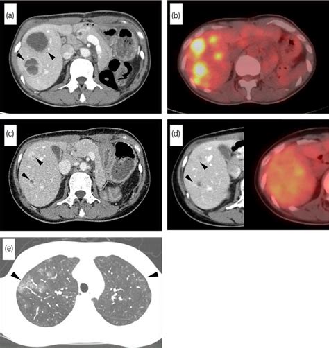 a at 4 months after starting edp‐m therapy contrast‐enhanced ct