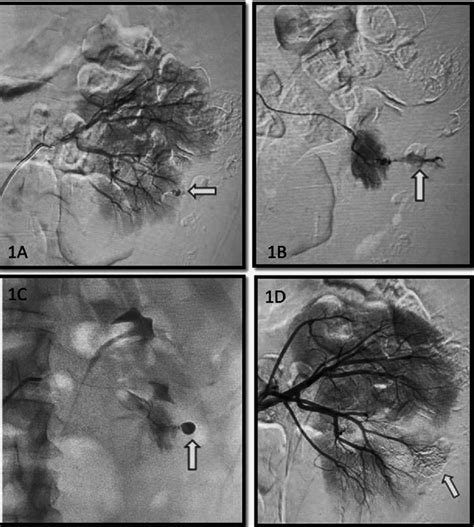 N Butyl 2 Cyanoacrylate Nbca In Nephron Sparing Superselective