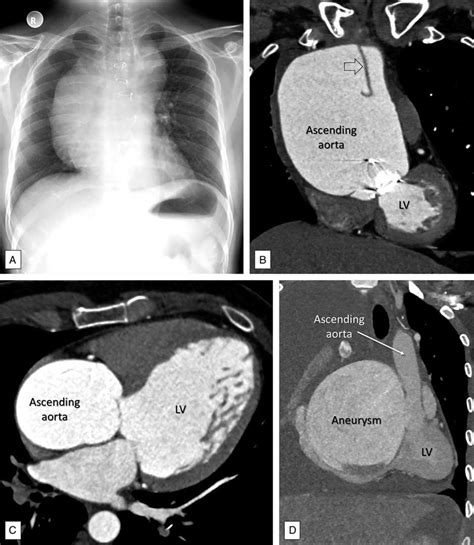 Aortic Root Ascending Aortic Aneurysm Frontal Chest Radiograph A Download Scientific Diagram