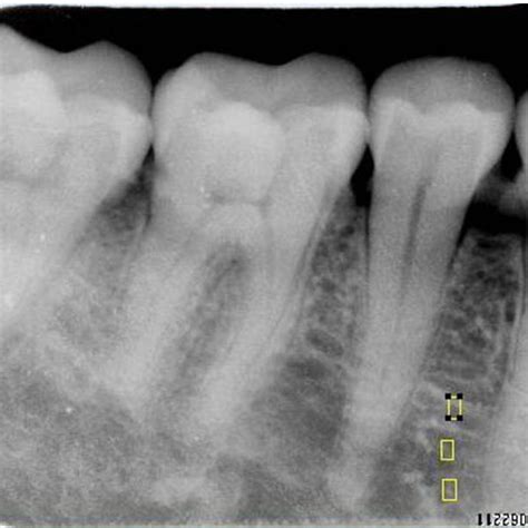 Clasification Of Mandibular Cortex Mandibular Index Method By Klemetti Download Scientific
