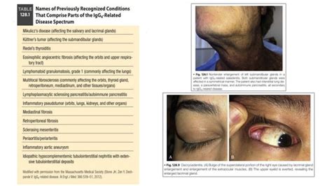 Igg4 Related Disease And It S Management Pdf