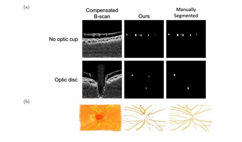 A Segmentation Network Performance On An Oct Image Withwithout An