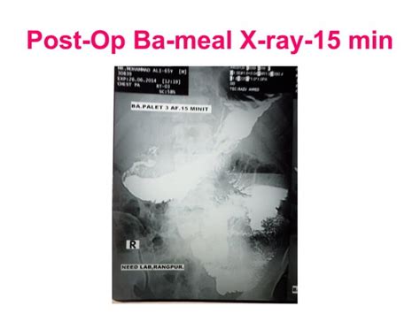 Post Operative Gastro Jejunostomy Efferent Loop Obstruction Due To Recurrent Ulcer With