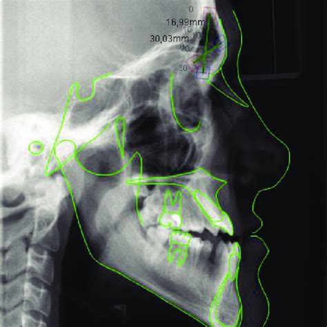 Determining Cephalometric Points And Evaluating Values Download Scientific Diagram