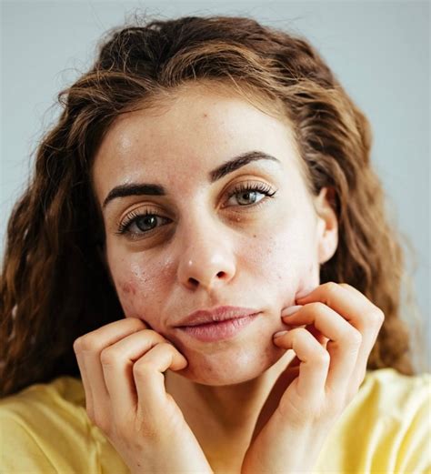 Utslag I Ansiktet Möjliga Orsaker Apohem