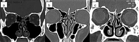 Coronal Ct Scans Of The Maxillary Sinuses A Bilateral Lateralized B