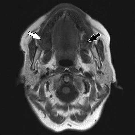 Mri Of Mandibular Osteonecrosis Secondary To Bisphosphonates Ajr