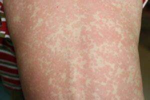 Macular Rash Derm Dx A Diffuse Erythematous Rash That Blanches With