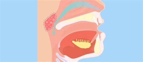 Adenoid Hypertrophy Grading