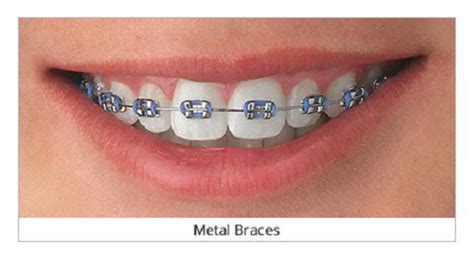 Latest Teeth Braces Colors Ideas Artofit