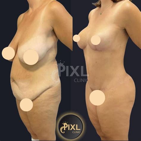 Tummy Tuck Before And After Pixl Clinic