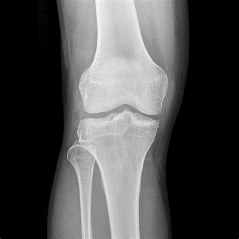 Knee Joint X Ray Image Ap View Stock Image Image Of Osteoporosis Limb 296615807