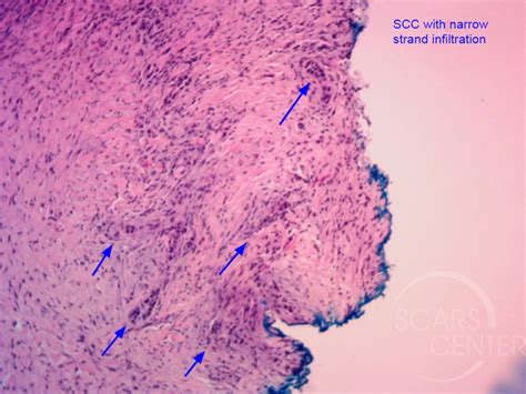 Forehead Scc With Perineural Invasion Skin Cancer And Reconstructive