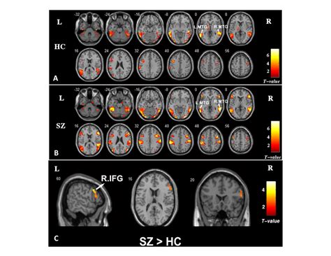 Brain Activation Patterns In The Groups Of A Healthy Controls Hc
