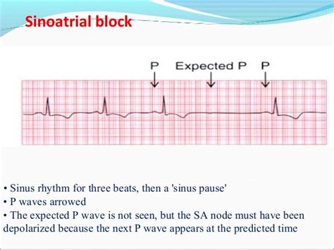 Ecg Basics Conduction Tissue