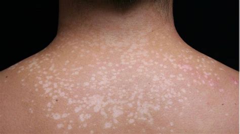 Tinea Versicolor Red Spots At Timothy Votaw Blog
