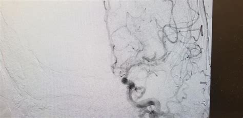 nishant ranawat on linkedin ccf fistula occluded after repeat angioplasty
