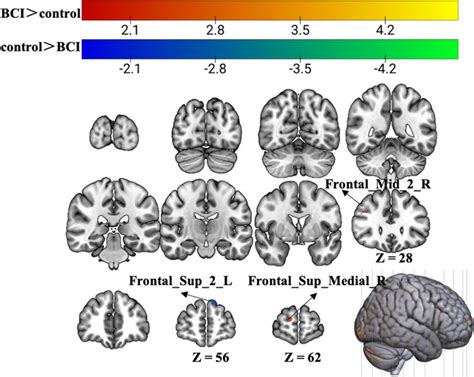 motor imagery based brain computer interface rehabilitation programs