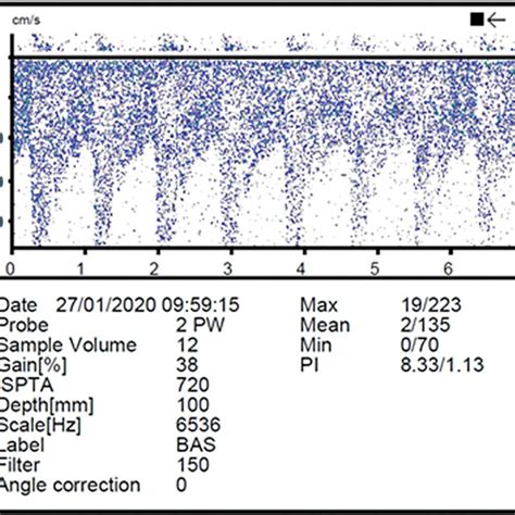 Systolic Flow Reversal In The Left Vertebral Artery At Transcranial