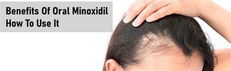 Benefits Of Oral Minoxidil And How To Use It Okdermo Skin Care