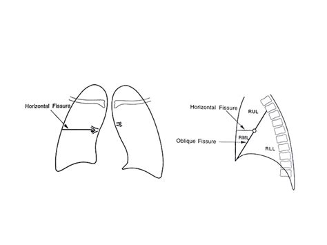 Collapse And Consolidation Lung Radiology Ppt