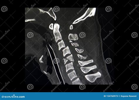 CT Scan Of Fractures Cervical Spines Royalty Free Stock Photo CartoonDealer