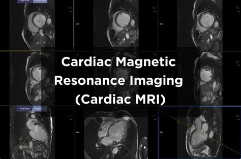 Cardiac Magnetic Resonance Imaging Mri Scan Bangkok Hospital Phuket International