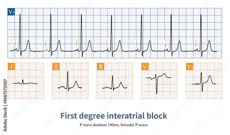 When The First Degree Interatrial Block Occurs The Conduction Time